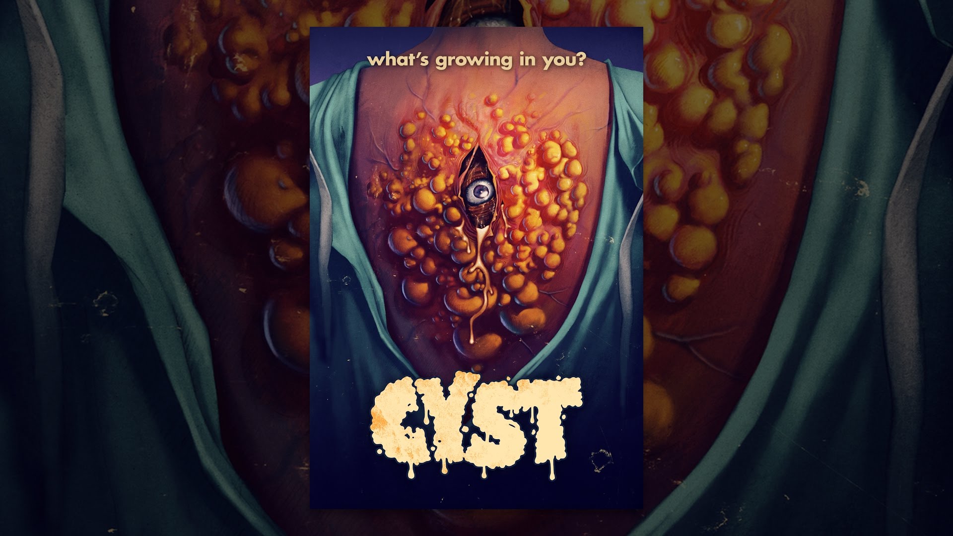 Cyst YouTube cyst-youtube
