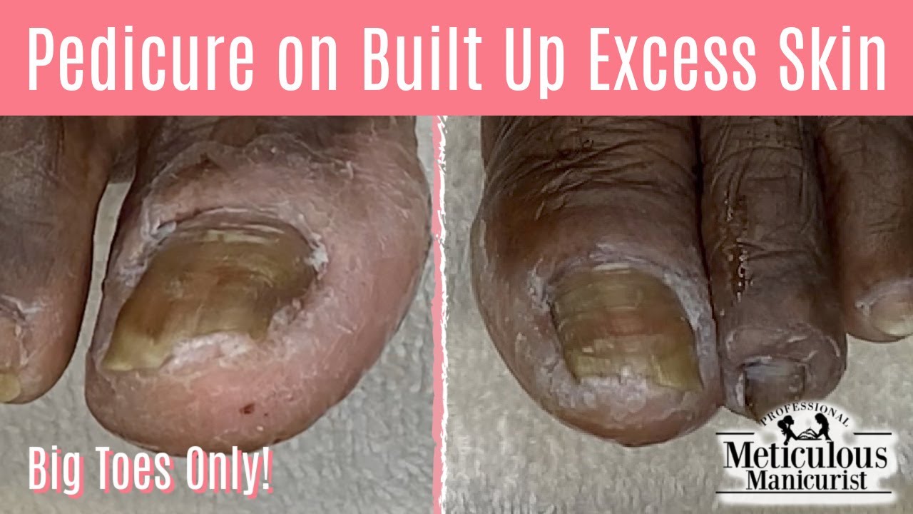 👣Big Toes Only - ASMR How to Pedicure Foot Care on Dry Impacted ...