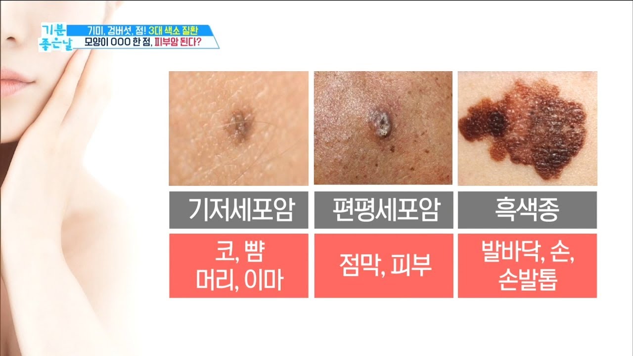 [HEALTH] If you have moles looks like this, suspect cancer,기분 좋은 날 ...