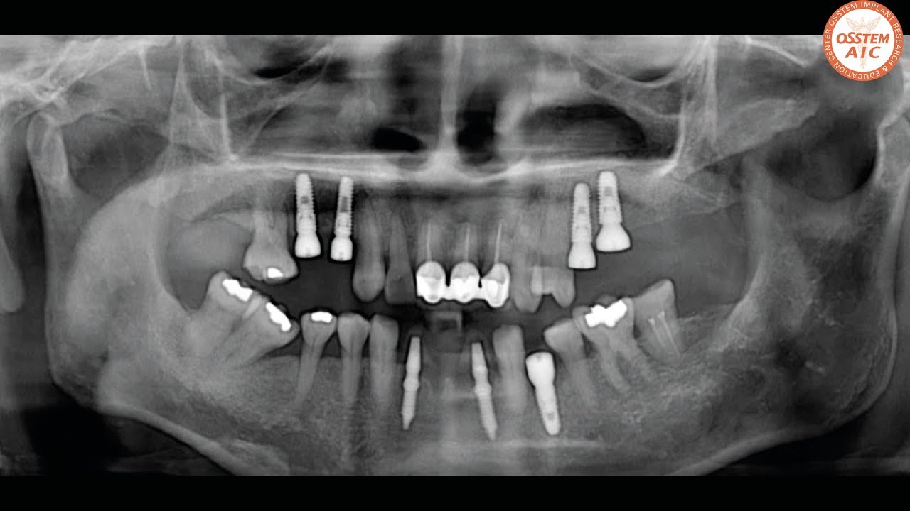 MS Kit операция - YouTube