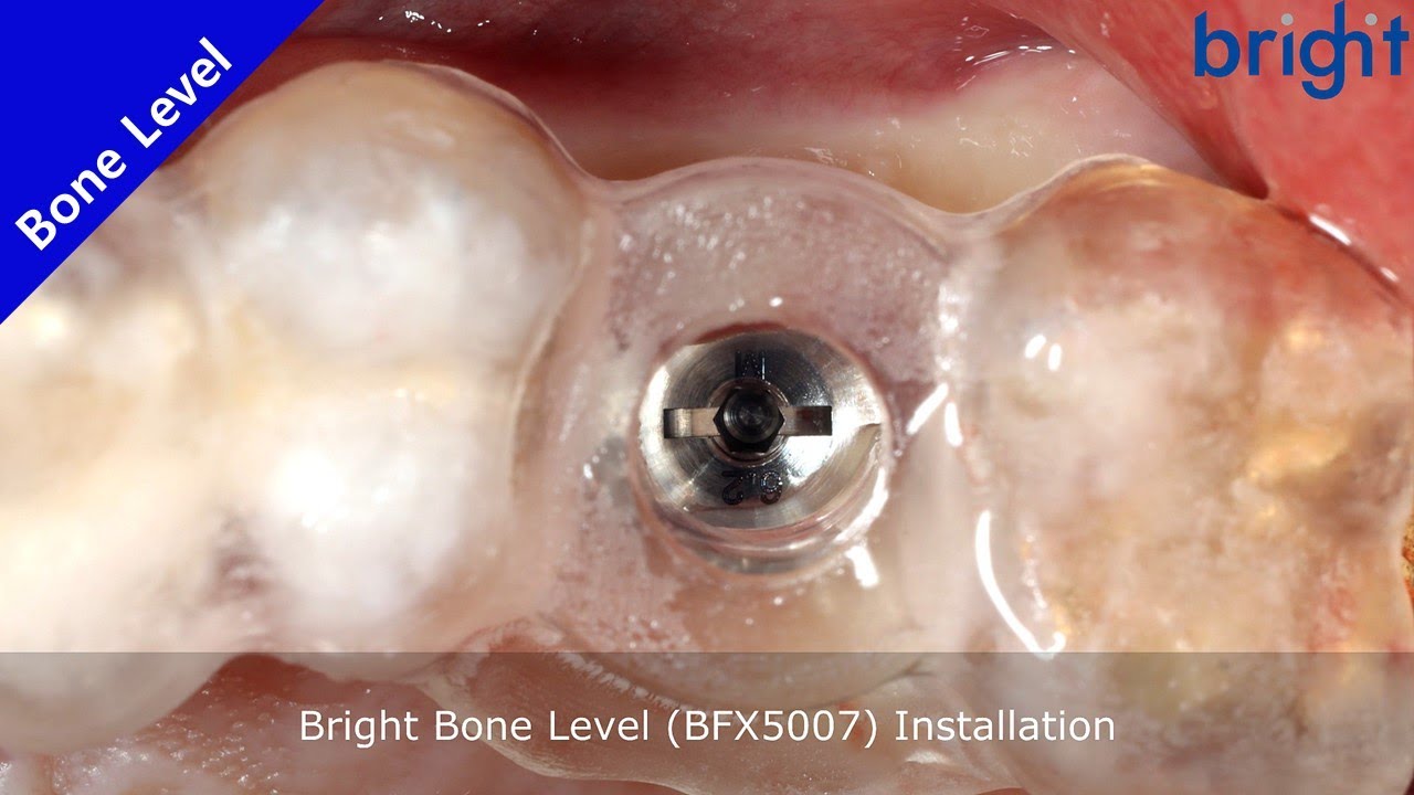 [The bright] Flapless Surgery using Digital Guide (Bone Level) - YouTube