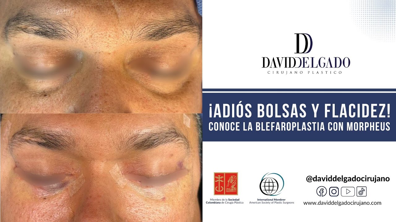 Blefaroplastia con Morpheus: Resultados increíbles para tus párpados ...