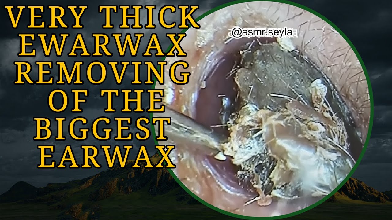 The Biggest Very Thick Earwax Removing Of The Biggest Earwax - YouTube
