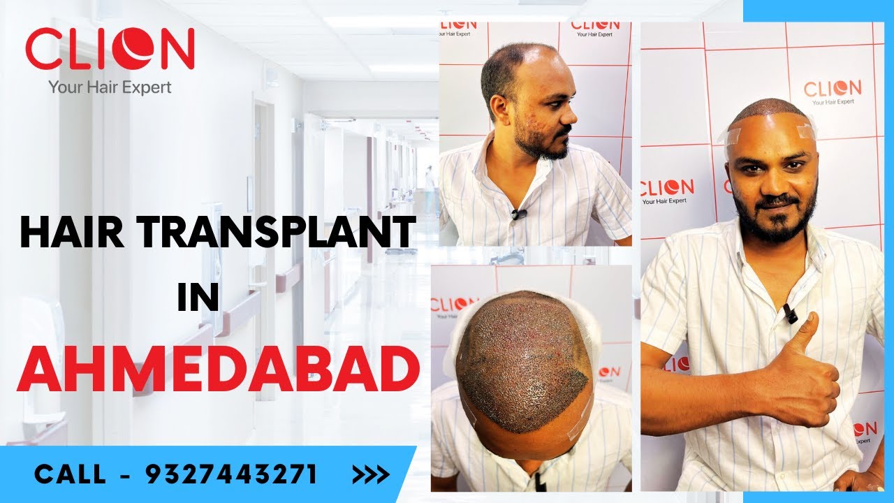 Hair Transplant in Ahmedabad | Best Hair Transplant Clinic in Ahmedabad ...