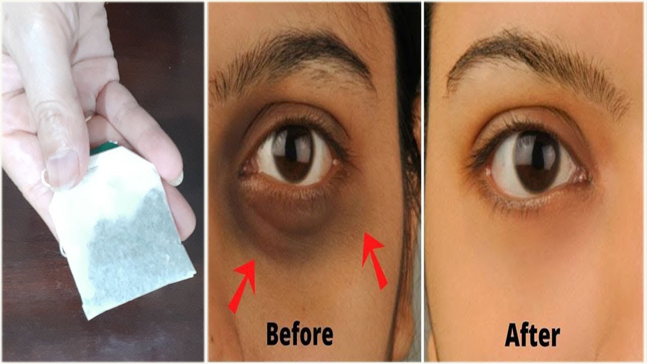 Remove Bag Under Eyes, Dark Circle and Wrinkles Around Eyes After One ...