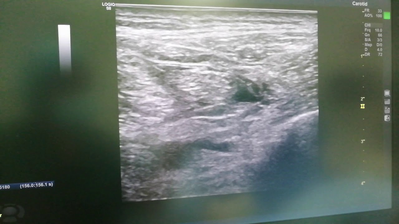 Ultrasound Guided popliteal sciatic nerve block - YouTube