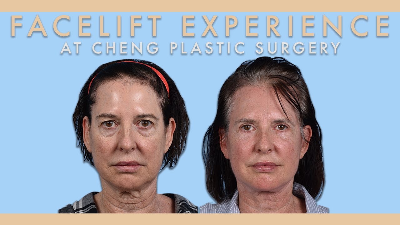 Facelift, Necklift, Eyelid Surgery & Forehead Lift at Cheng Plastic ...