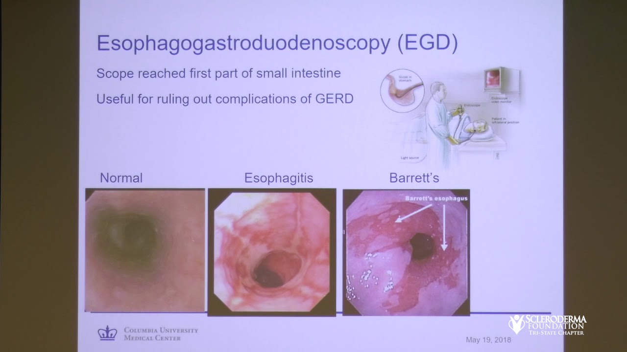 Esophageal Dysmotility