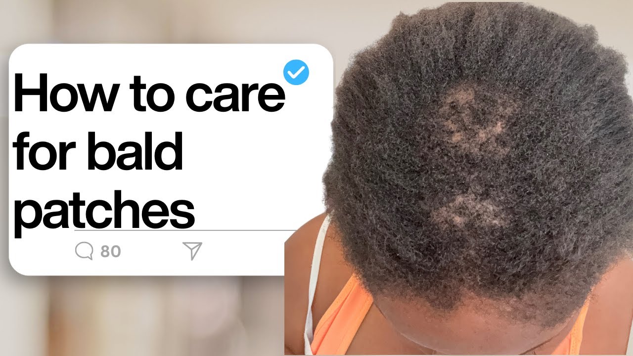 How to Treat Bald patches from relaxers - YouTube