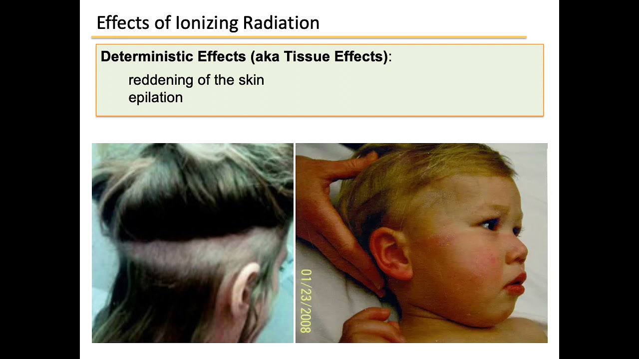Radiation Biology Part 2 - Deterministic Effects - YouTube