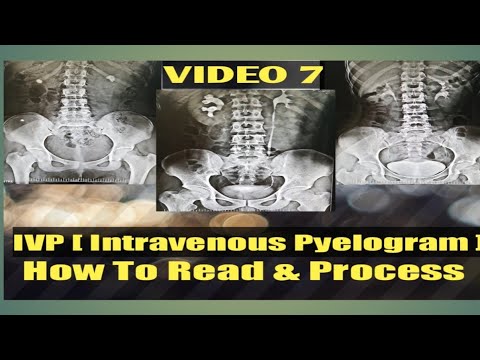 IVP Xray Procedure In Hindi || IVP Test For Kidney - YouTube