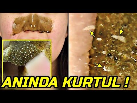SİYAH NOKTA TEMİZLEME MASKESİ \
