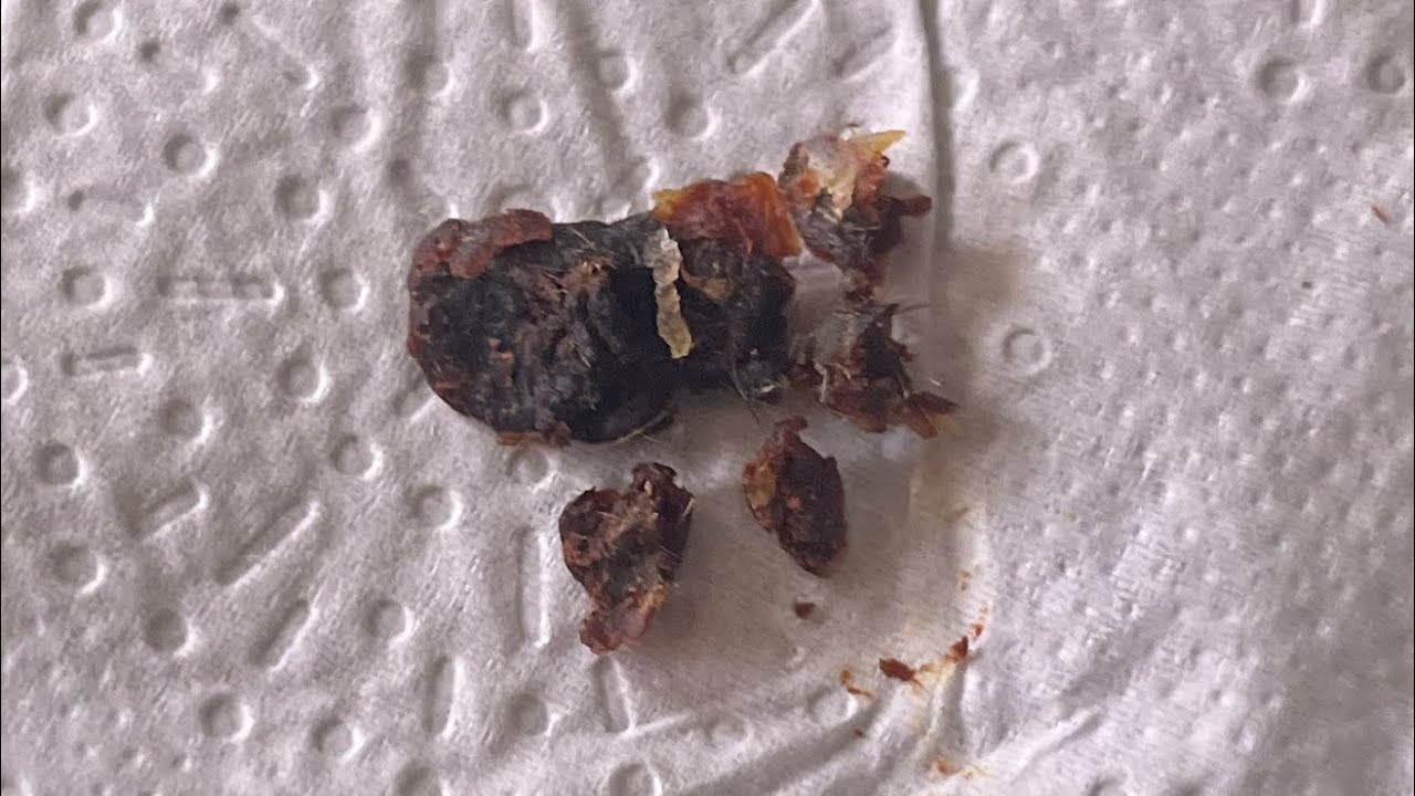 Ear Wax Removal - Mega Lump of Ear Wax Removed! - YouTube