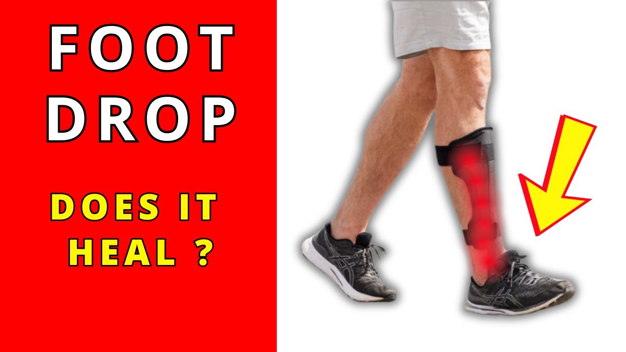 How long it takes to heal the Foot Drop? - YouTube