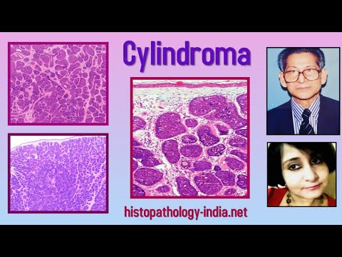 Pathology of Cylindroma by Dr Sampurna Roy MD ( dermatopathology ...