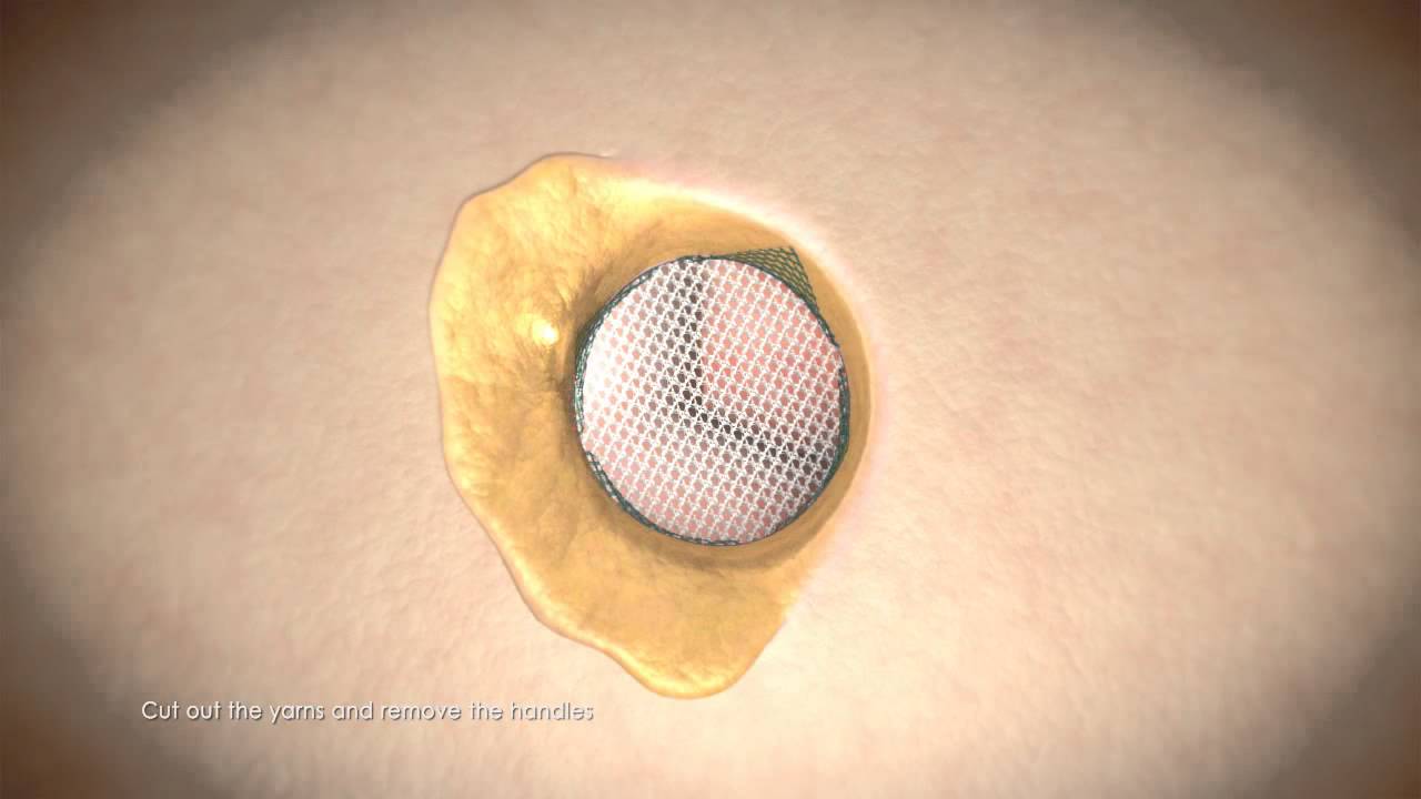 Parietex™ Composite Ventral Patch Animated Video - YouTube