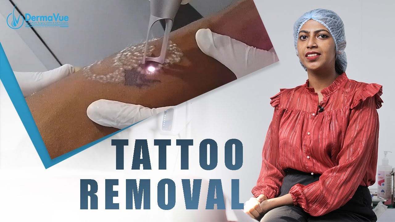 Erase the Past: Laser Tattoo Removal Explained ലേസർ ടാറ്റൂ റിമൂവ ...