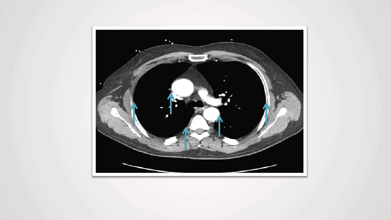Getting into the chest X-ray: The importance of overlap (part 2) - YouTube