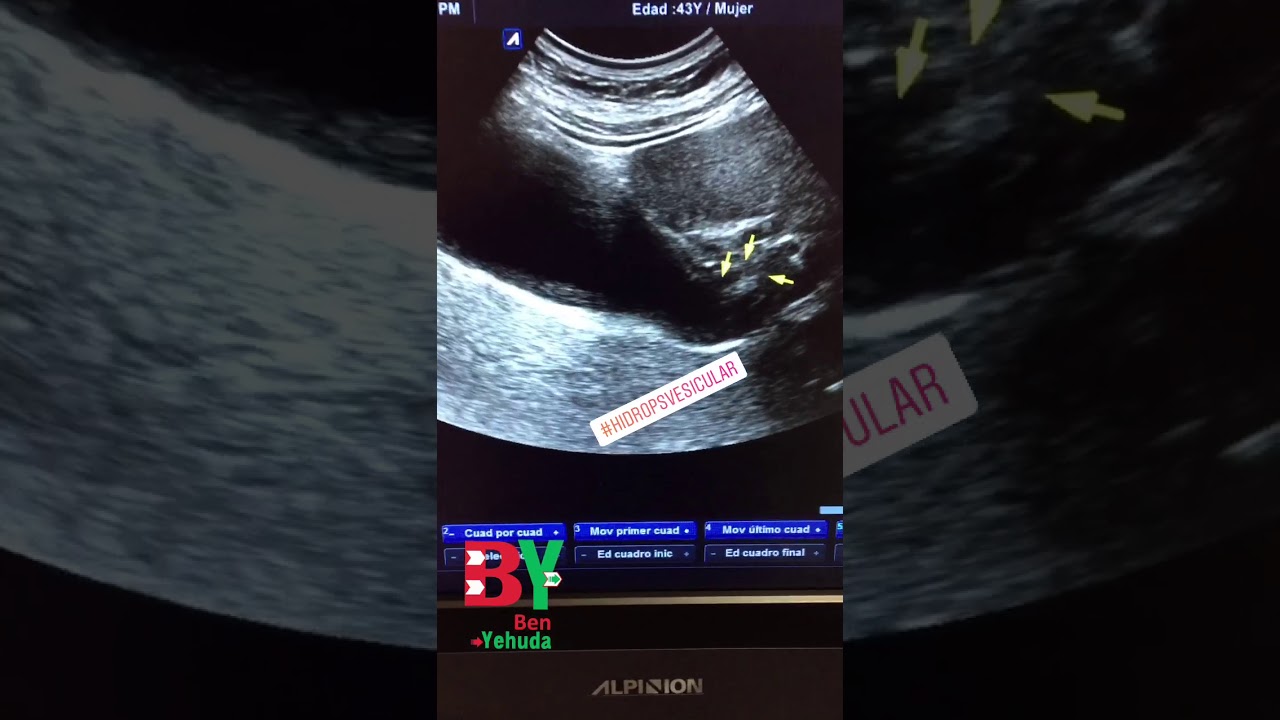 Hidrops vesicular - YouTube