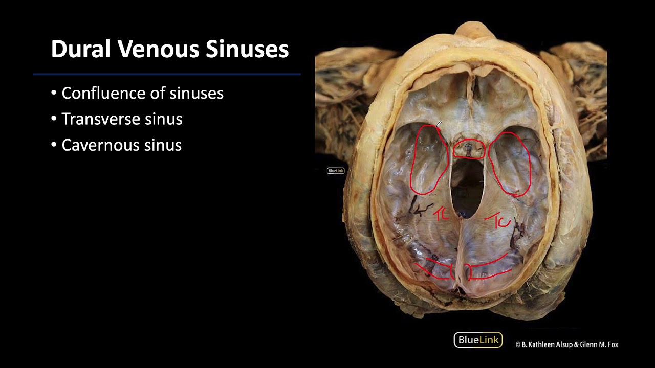 Dural Venous Sinus - Dissection Supplement - YouTube