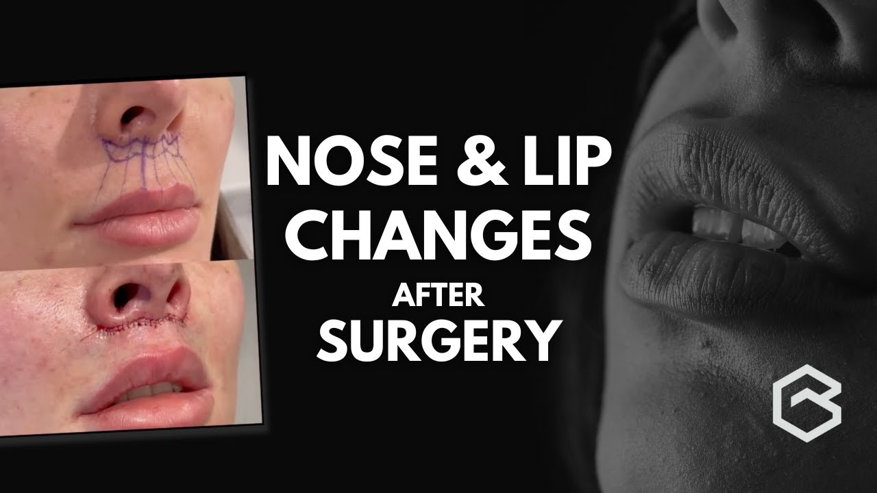 Nose & Lip Changes After Surgery | Dr. Greg Bran - YouTube
