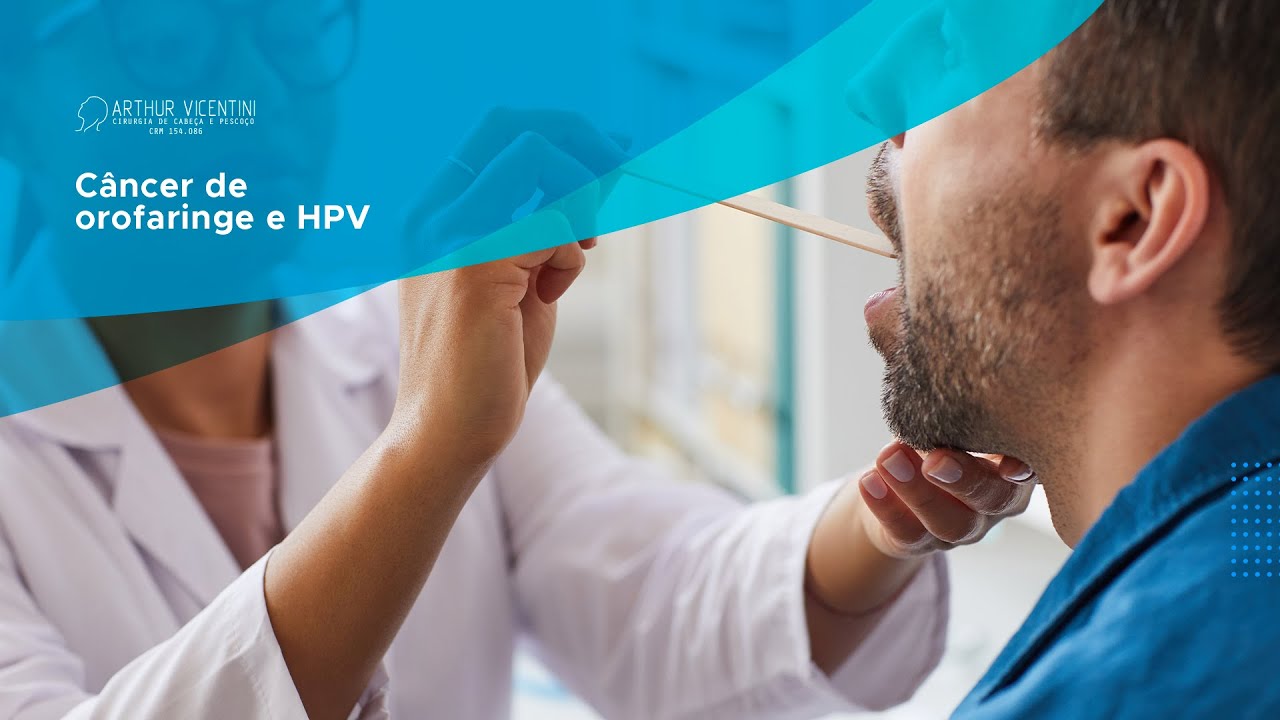 Câncer de orofaringe e HPV | Dr. Arthur Vicentini CRM 154.086 - YouTube
