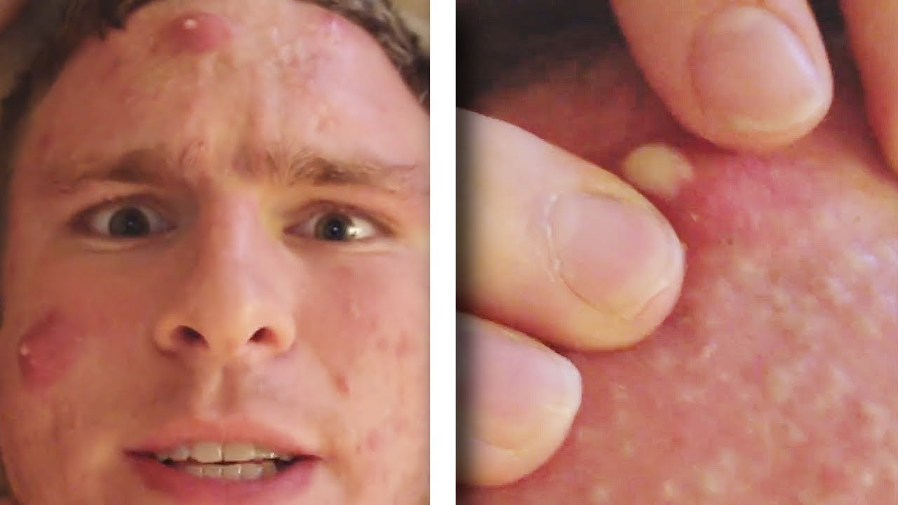 I FORCED MY PIMPLE TO POP AND WHAT HAPPENED! - YouTube