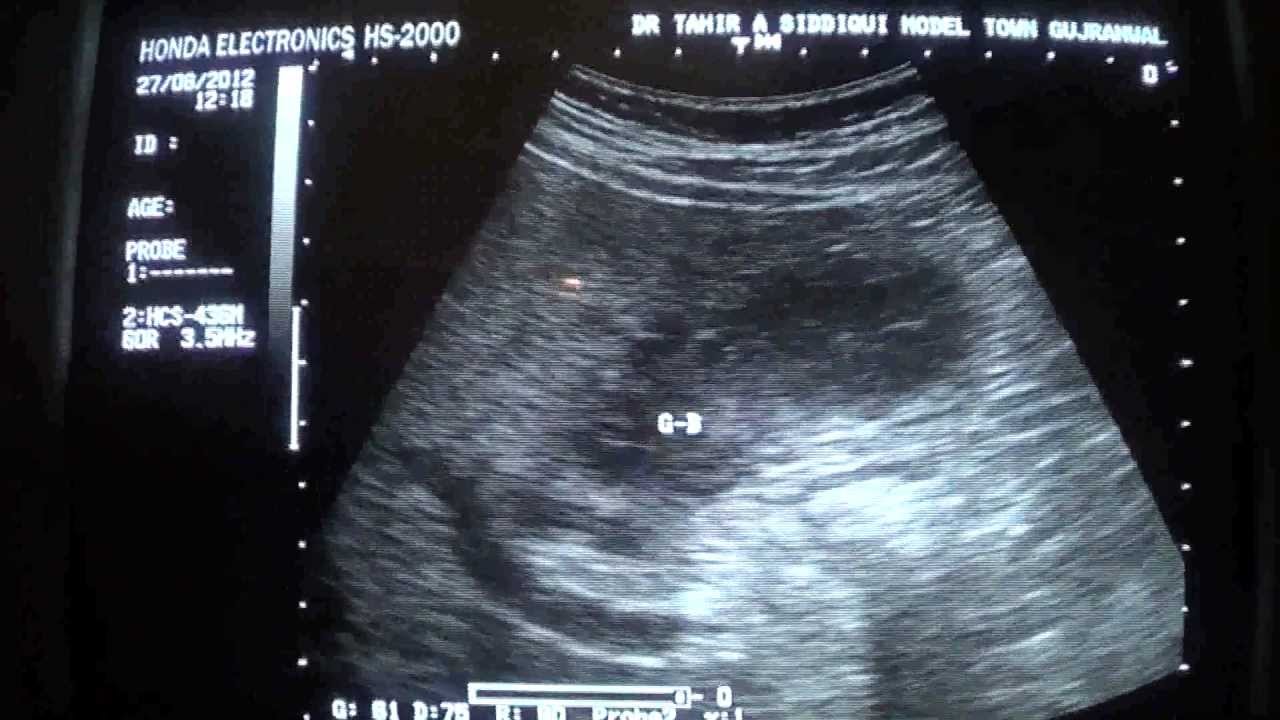 acute cholecystitis with cholecystolithiasis - YouTube