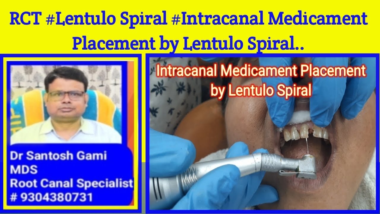 RCT # Lentulo Spiral # Intracanal Medicament Placement by Lentulo ...