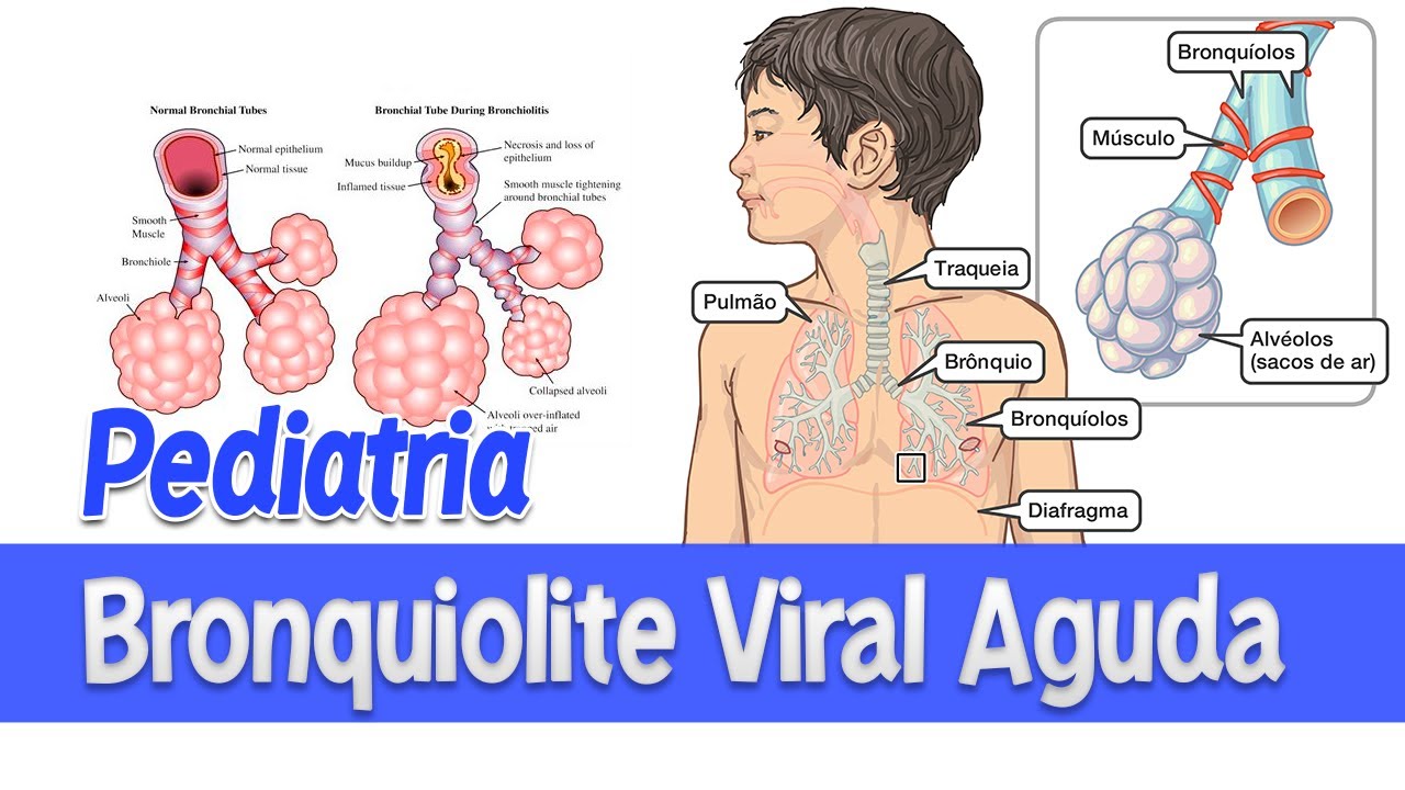 O que é a Bronquiolite Viral Aguda? │ Pediatria - YouTube