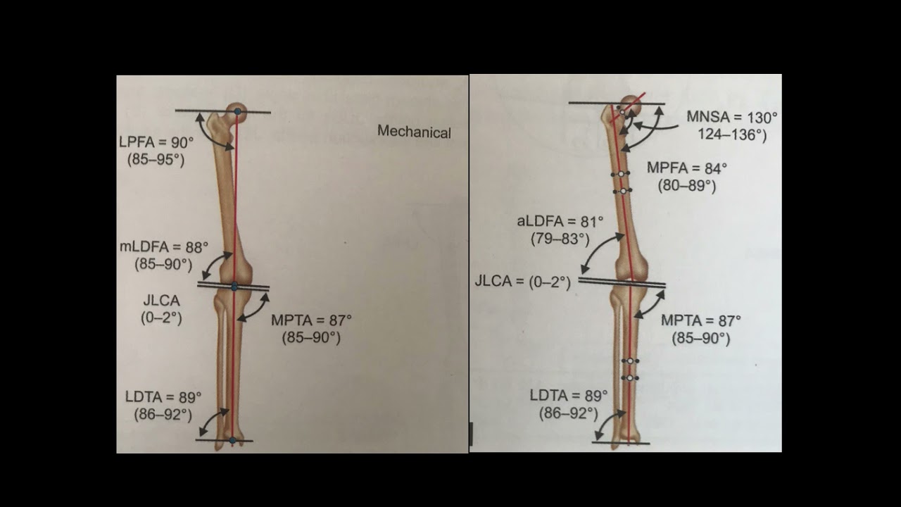 Understanding Alignment and Varus Knee for Total Knee Replacement - YouTube