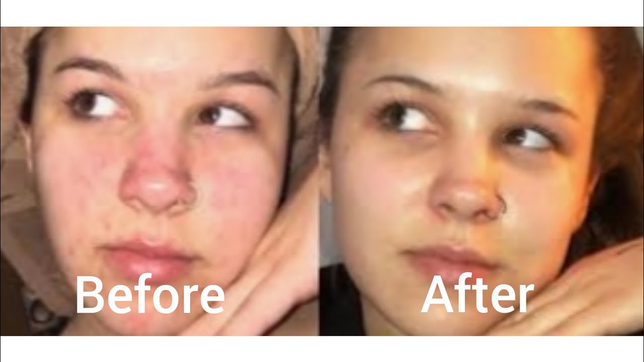Easy remedy on How to get a clear skin ( Ance Treatment) - YouTube