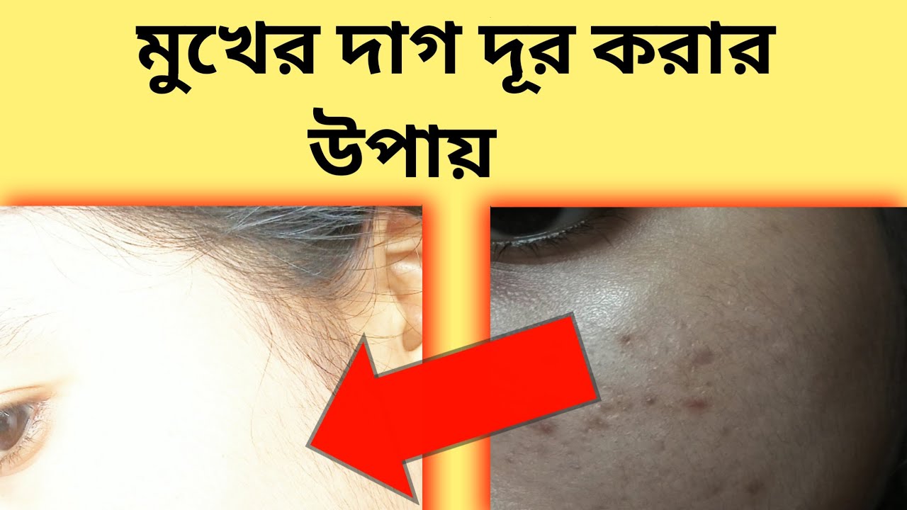 মুখের ব্রণের দাগ দূর করার উপায় How To Remove Spots From Face Bd Beauty Roseline Youtube