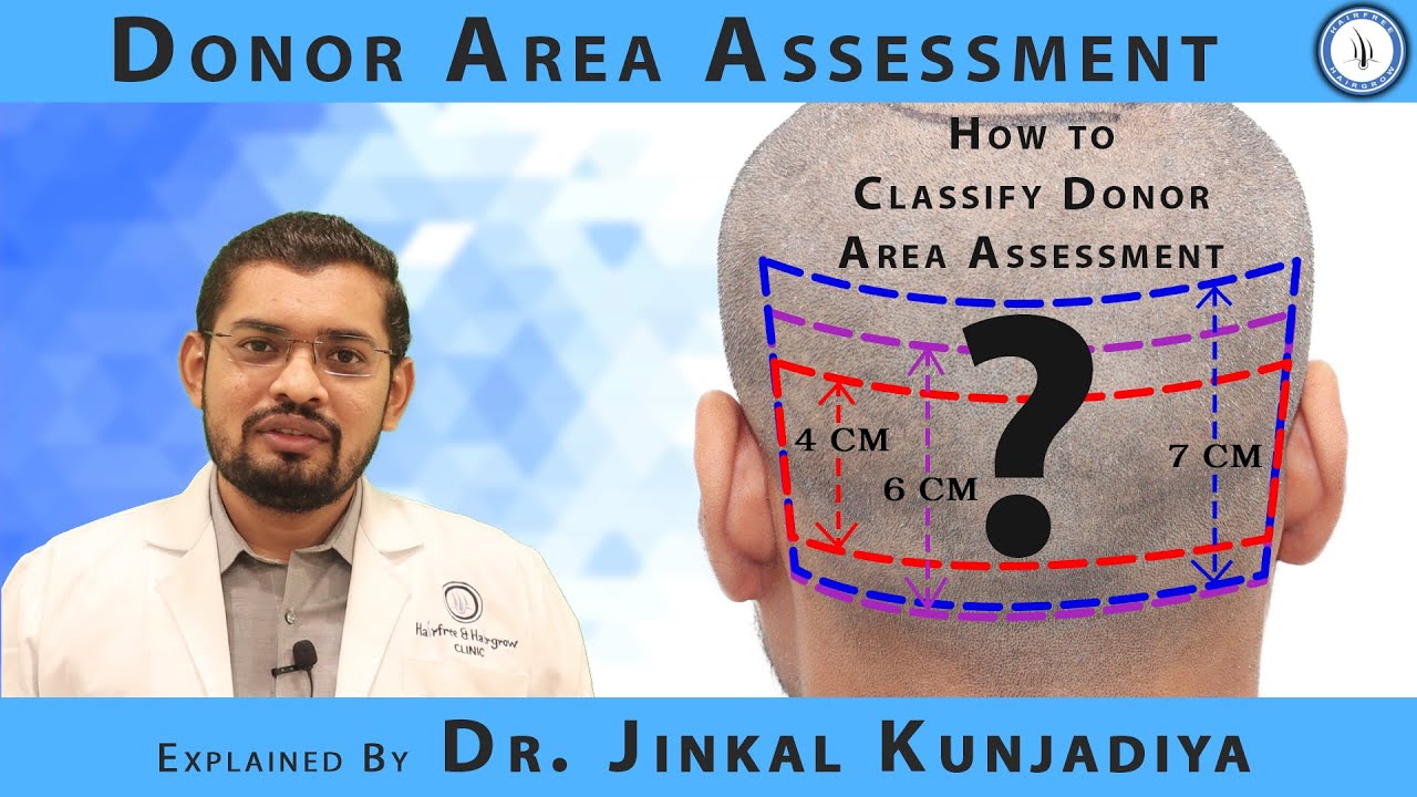 Donor Area Assessment & Grafts Estimation -By Dr. Jinkal Kunjadiya ...