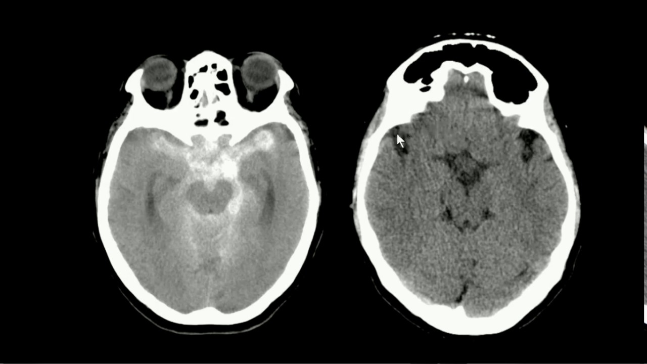 Hemorragia subaracnoide - Subarachnoid hemorrhage - YouTube