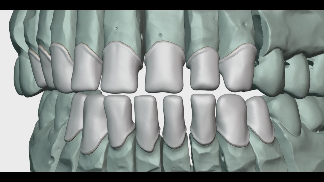 B4D Dental Modules - Crown Module in action - YouTube