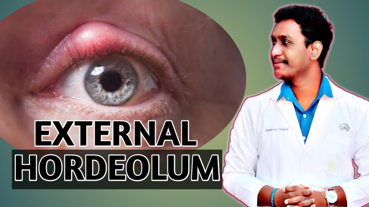 External Hordeolum eyelid Diseases external Hordeolum Case external-hordeolum-eyelid-diseases-external-hordeolum-case