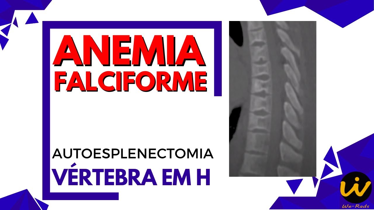 ANEMIA FALCIFORME - VÉRTEBRA em H e AUTOESPLENECTOMIA - YouTube
