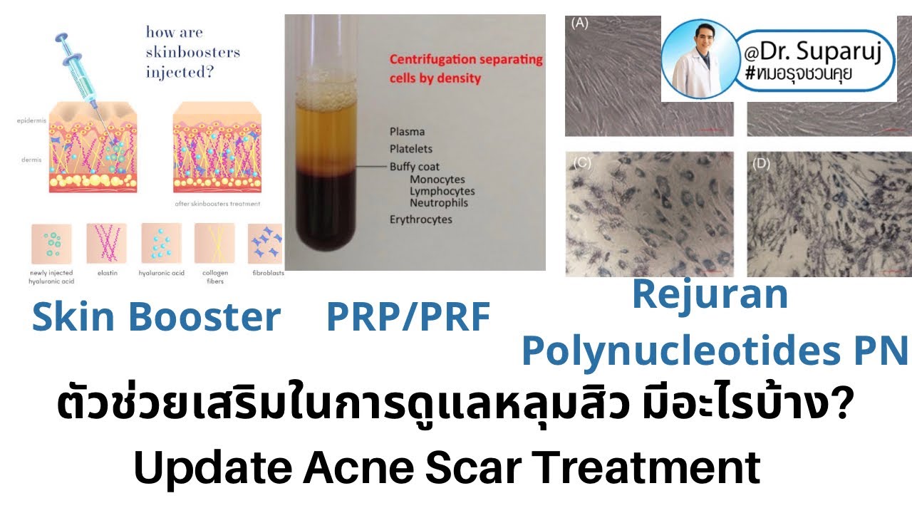 Update ตัวช่วยเสริมรักษาหลุมสิวมีอะไรบ้าง? Skin Booster PRP Rejurans ...