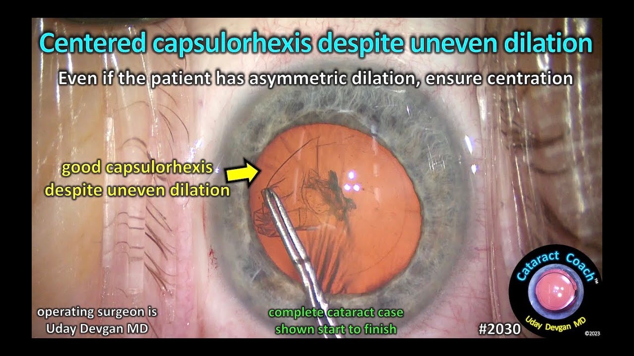 CataractCoach™ 2030: centered capsulorhexis despite uneven dilation ...