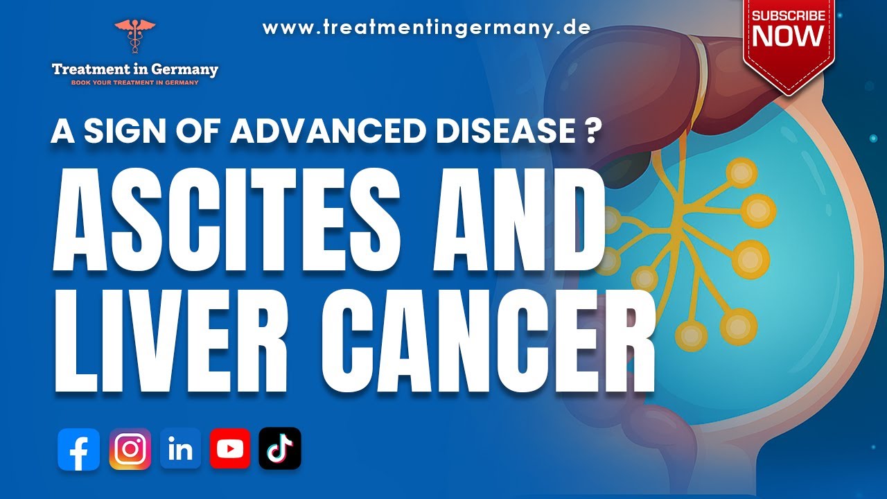 Is Ascites A Sign of Liver Cancer? | Treatment in Germany - YouTube