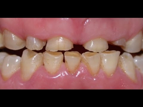 Surgical Crown Lengthening on Severe Tooth Surface Loss. - YouTube