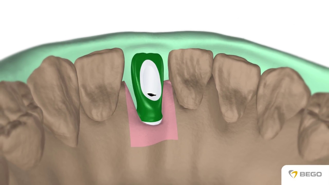 BEGO Implant Systems – Universal Aufbau / Universal abutment - YouTube