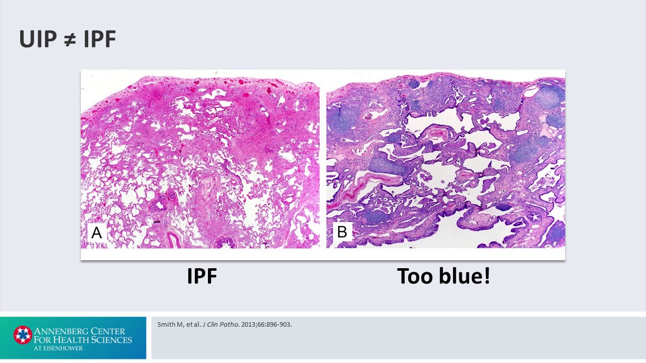 Evaluation and Diagnosis A: Usual Interstitial Pneumonia - Interstitial ...