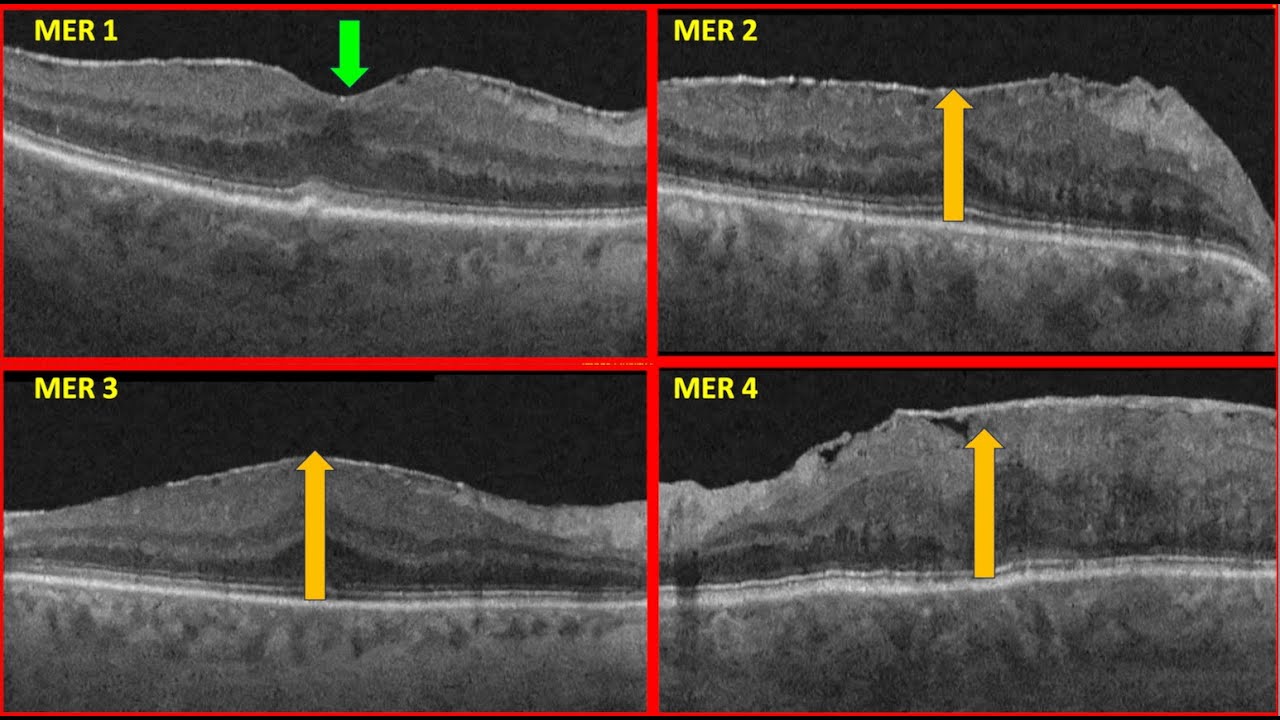 Clasificación de la MER - YouTube
