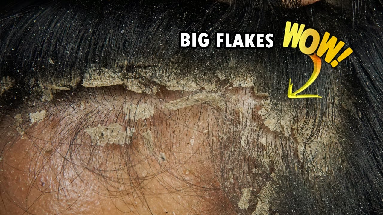Best Big Flakes Of Dandruff Scratching Satisfying #439 - YouTube