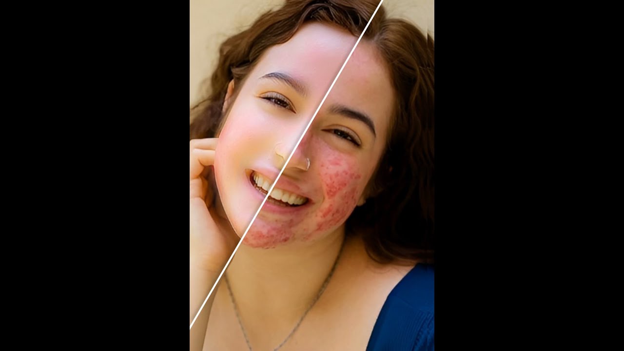 How to Remove Acne - Adobe Photoshop Tutorial #design #graphicdesign # ...