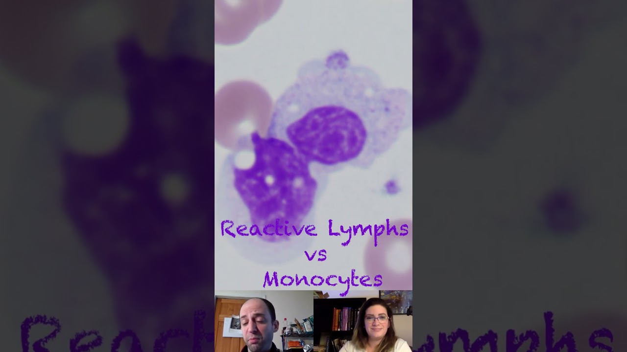 Reactive Lymphocytes Vs Monocytes