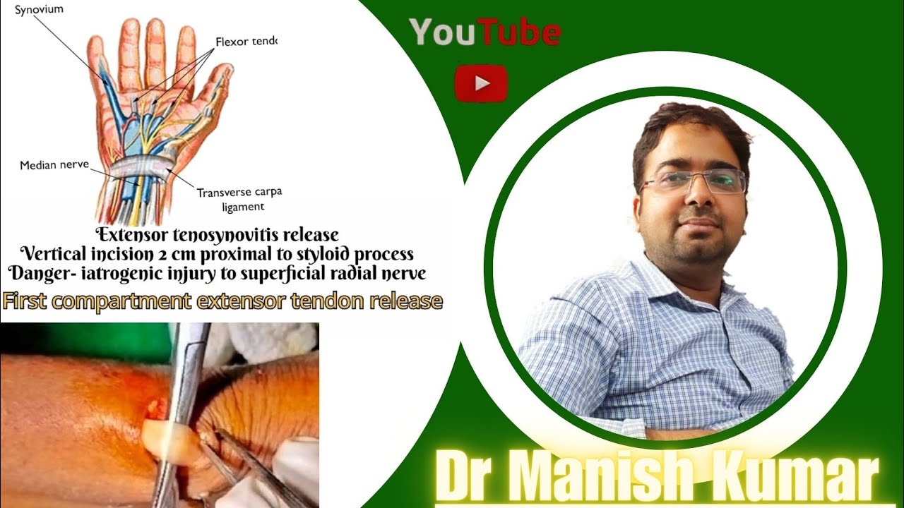 First compartment extensor tendon release- by @DR_manishkumar //De ...