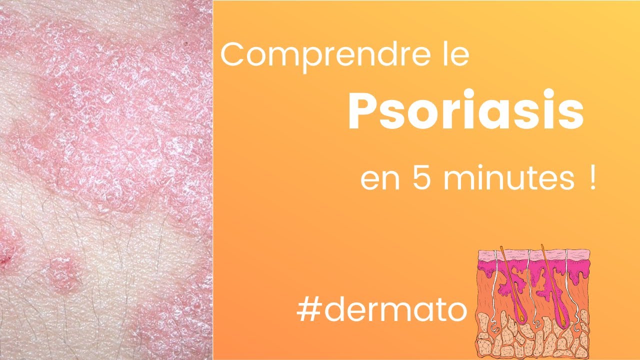 Le psoriasis en 5 minutes - Cours dermatologie | Revisimed - YouTube